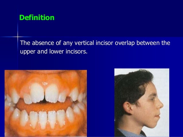 Anterior Open Bite and Deep Bite