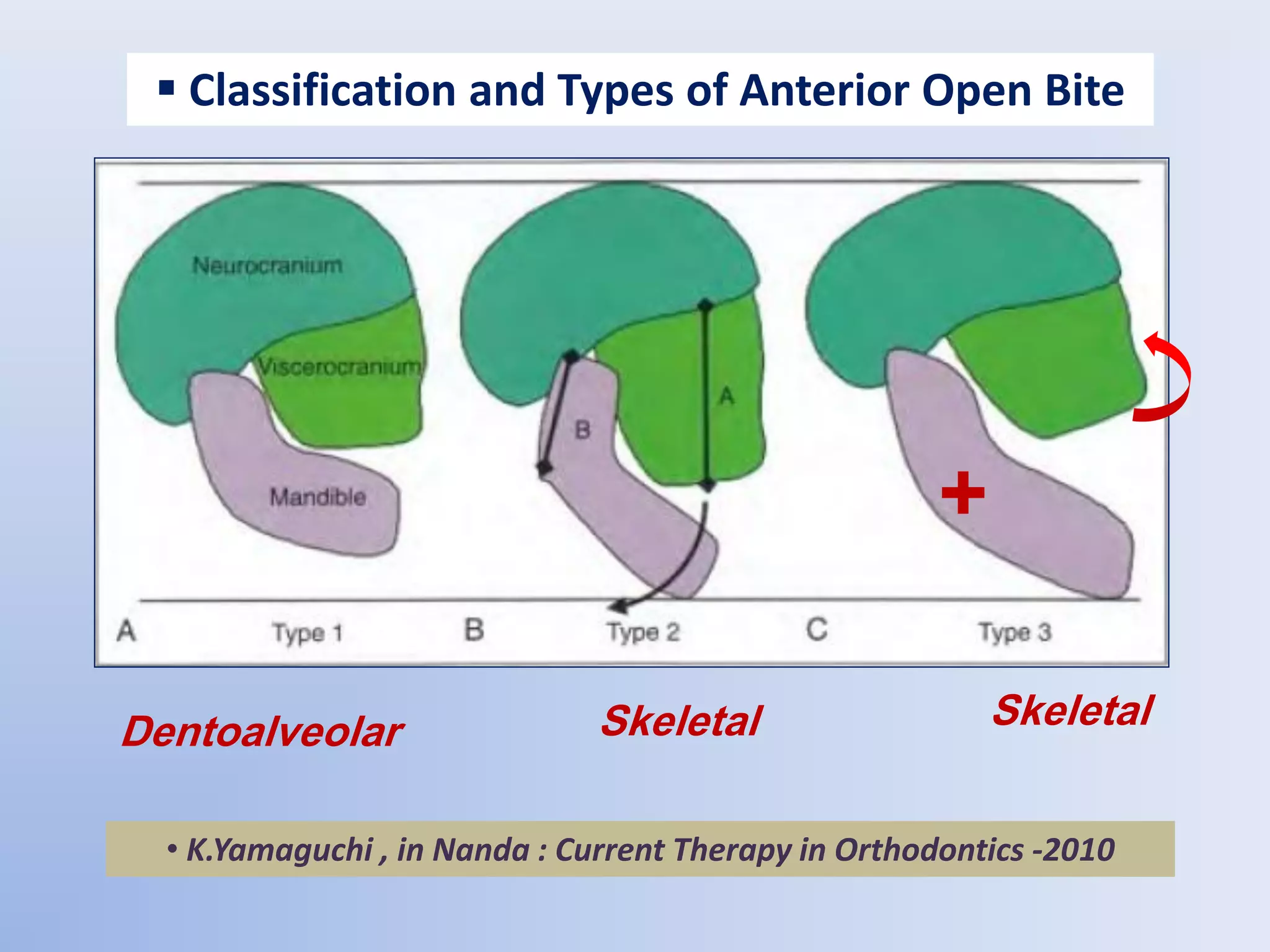 Anterior Open Bite etiology and differential diagnosis | PDF