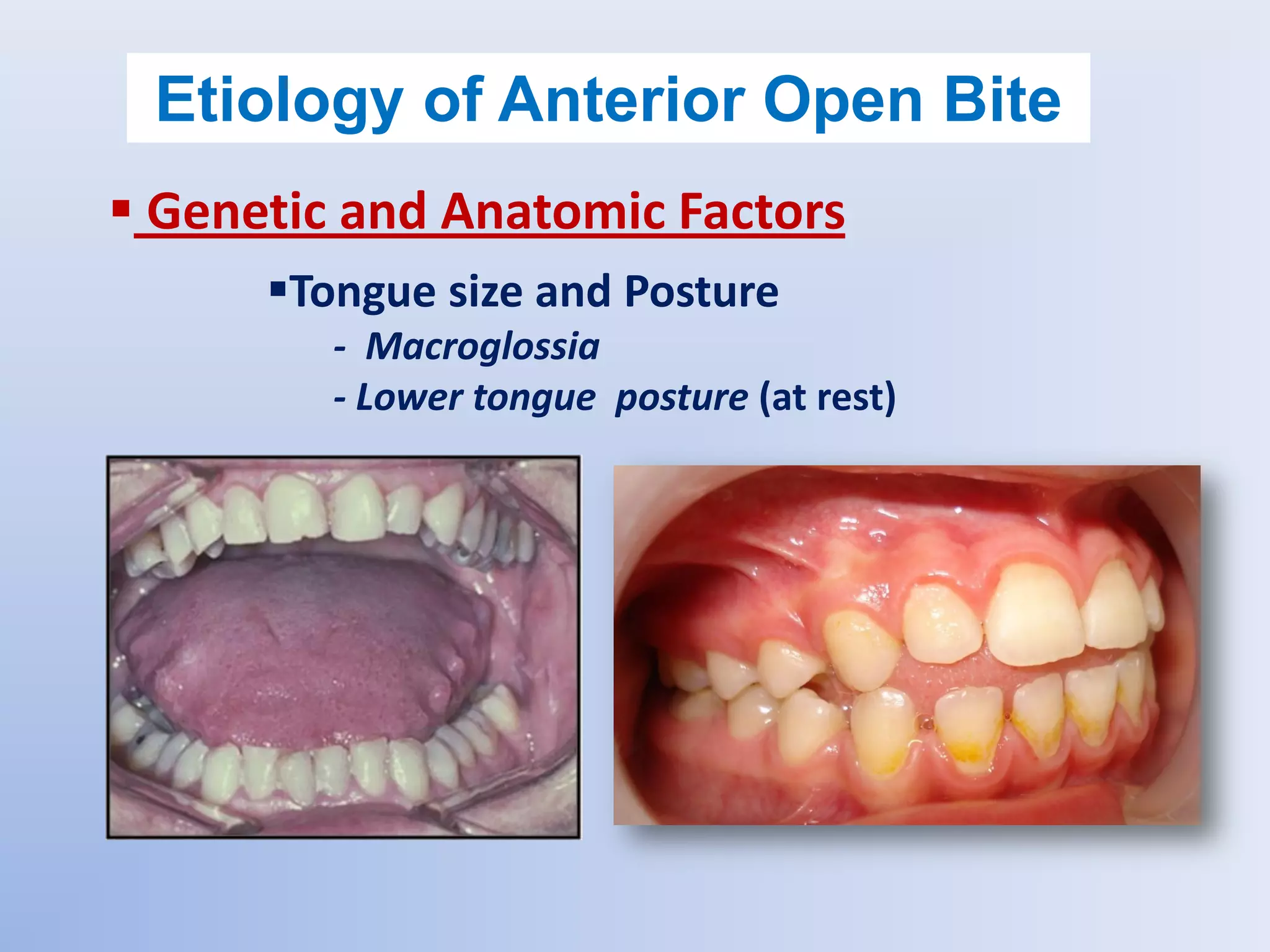 Anterior Open Bite etiology and differential diagnosis | PDF