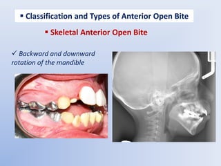 Anterior Open Bite etiology and differential diagnosis | PDF