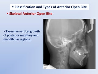 Anterior Open Bite etiology and differential diagnosis | PDF