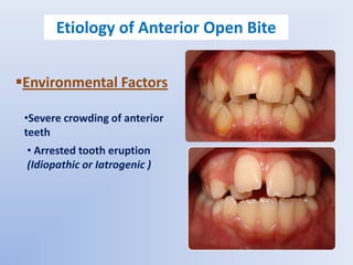 Anterior Open Bite etiology and differential diagnosis | PDF