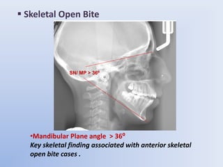 Anterior Open Bite etiology and differential diagnosis | PDF