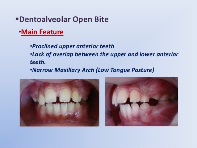 Anterior Open Bite etiology and differential diagnosis