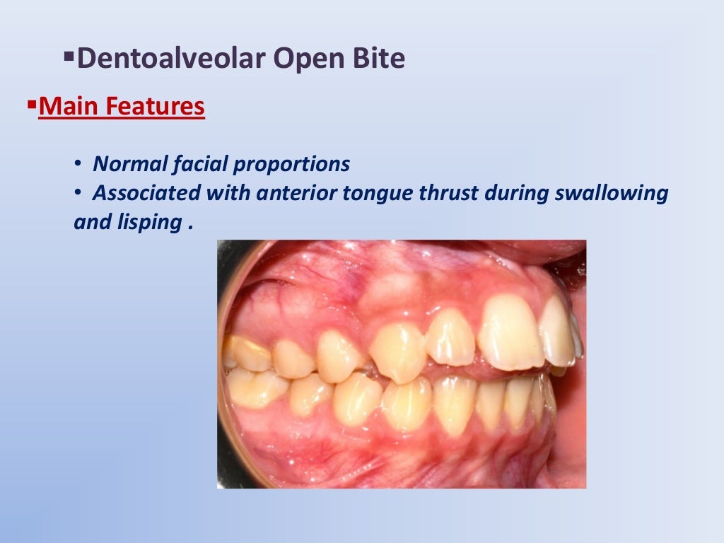 Anterior Open Bite etiology and differential diagnosis
