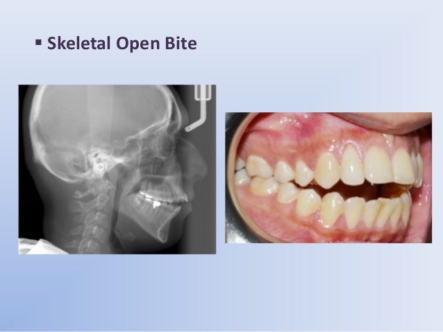 Anterior Open Bite etiology and differential diagnosis