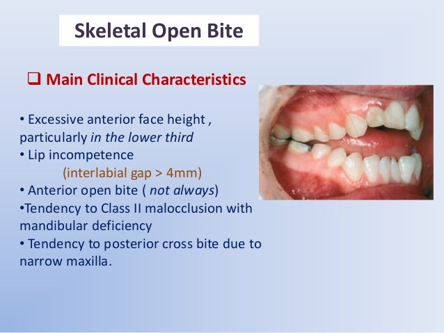 Anterior Open Bite etiology and differential diagnosis