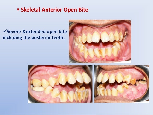 Anterior Open Bite etiology and differential diagnosis