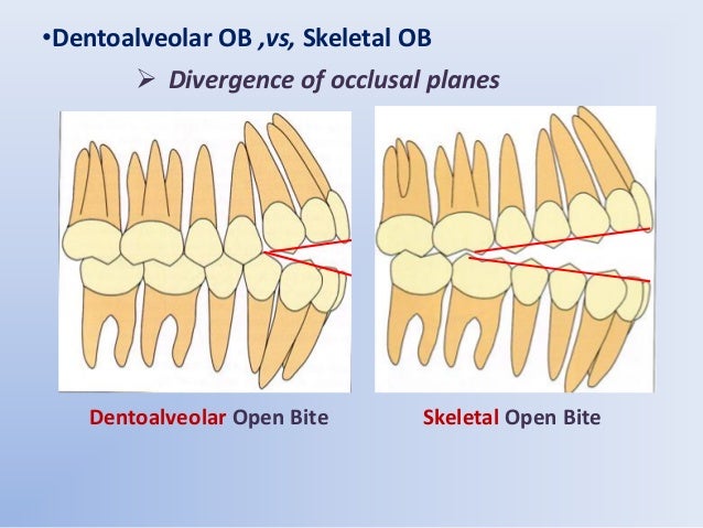 Anterior Open Bite etiology and differential diagnosis