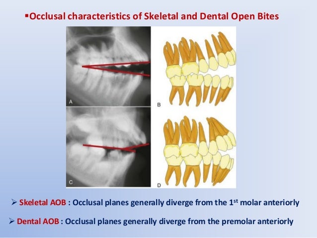 Anterior Open Bite etiology and differential diagnosis