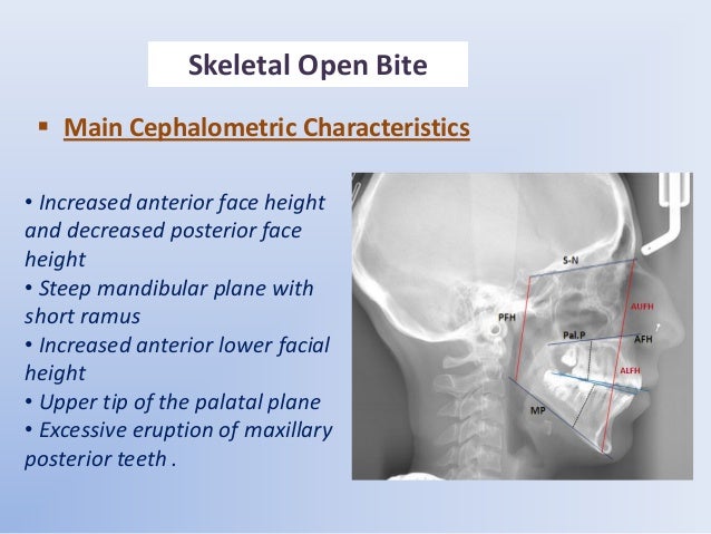 Anterior Open Bite etiology and differential diagnosis