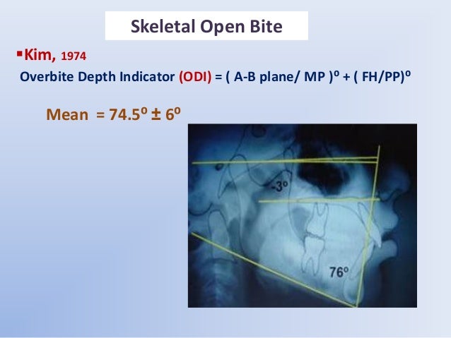 Anterior Open Bite etiology and differential diagnosis