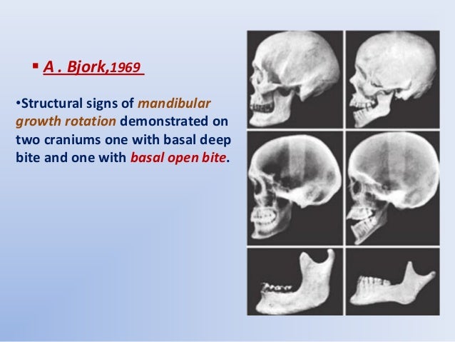 Anterior Open Bite etiology and differential diagnosis