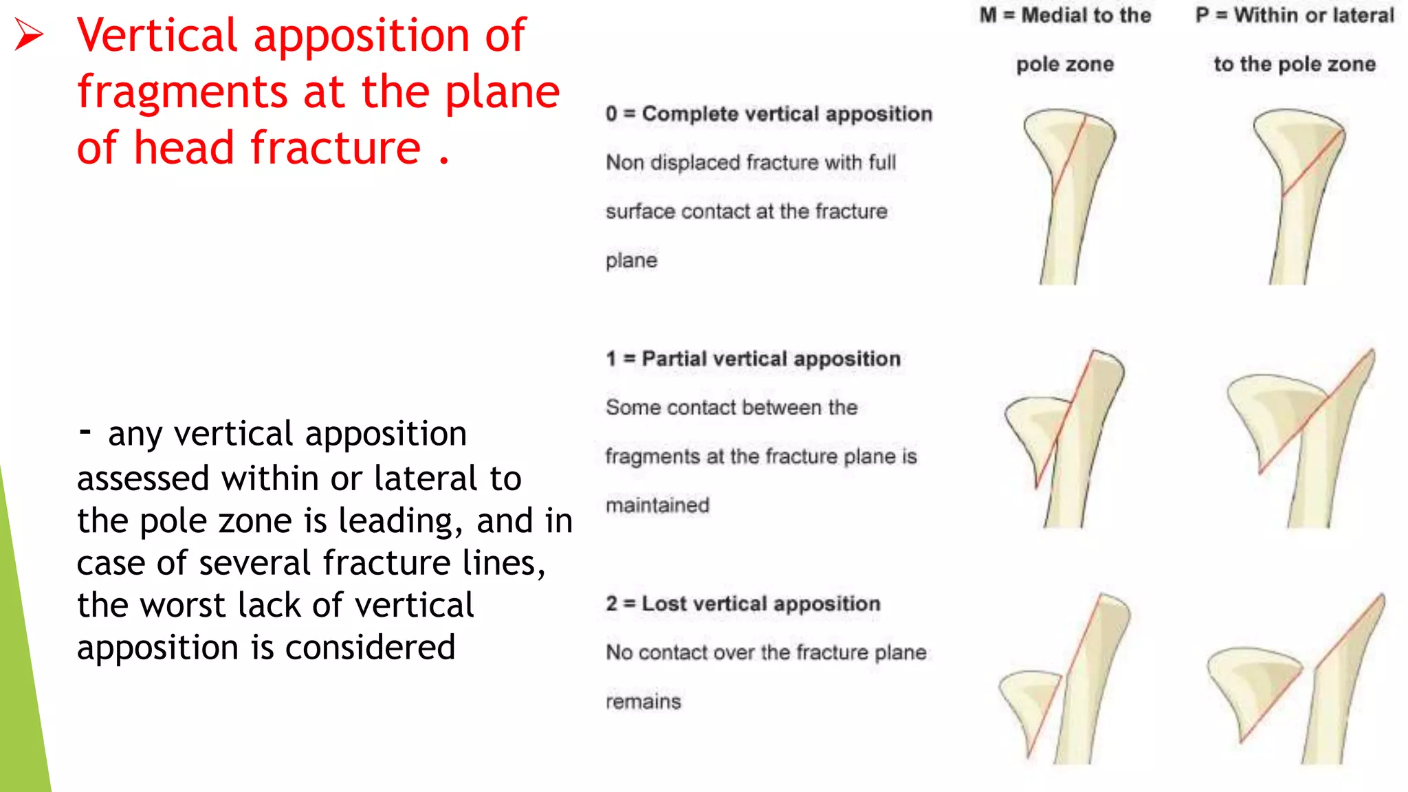 Aocmf classification . 2014, level 3 , condylar fracture , | PPTX