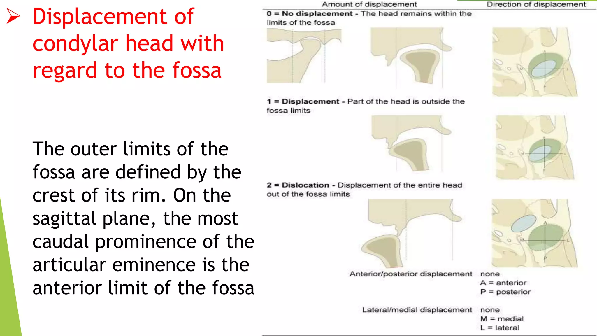 Aocmf classification . 2014, level 3 , condylar fracture , | PPTX