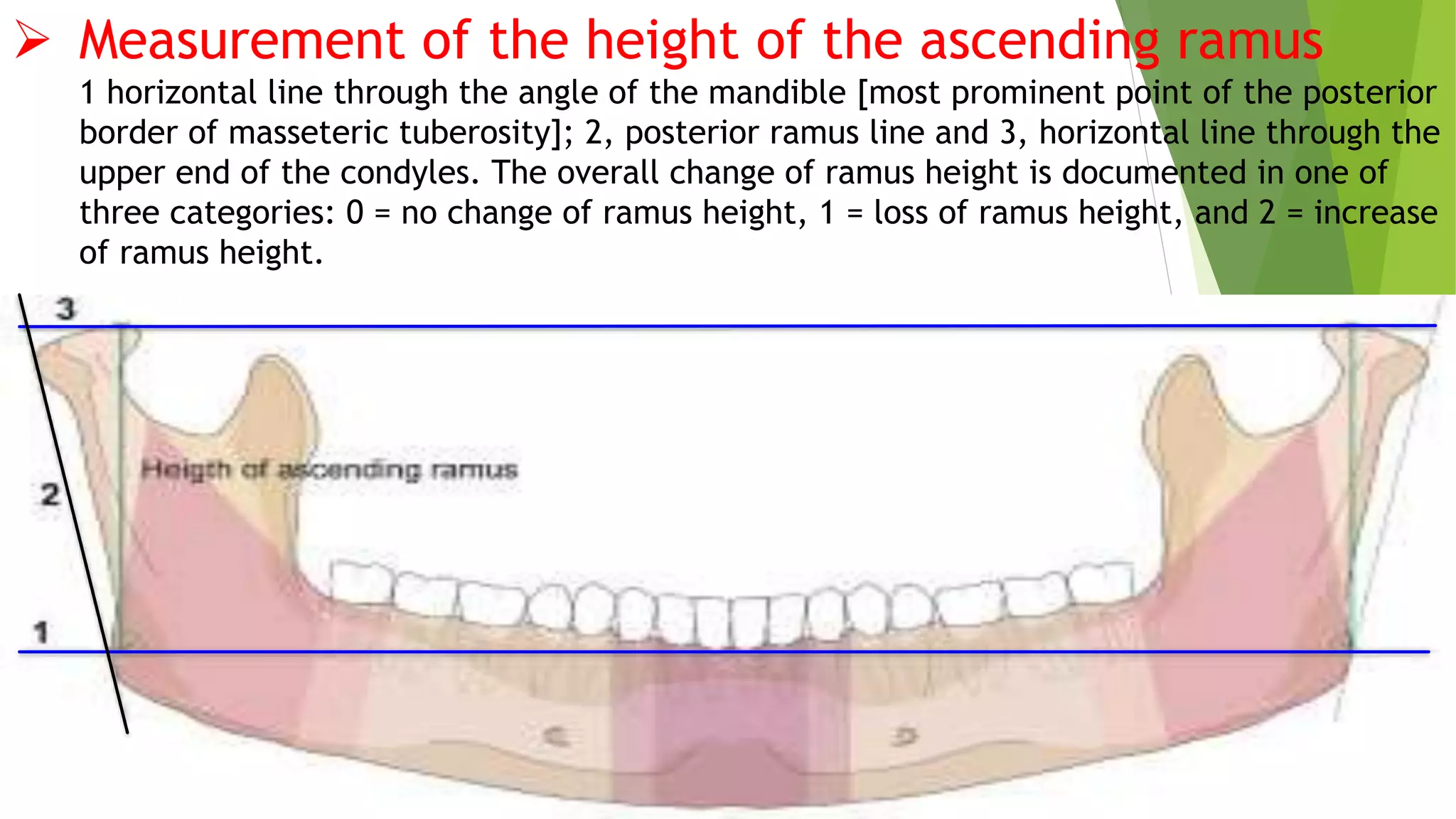 Aocmf classification . 2014, level 3 , condylar fracture , | PPTX