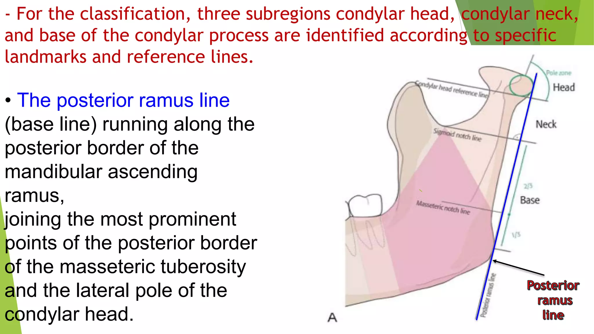 Aocmf classification . 2014, level 3 , condylar fracture , | PPTX