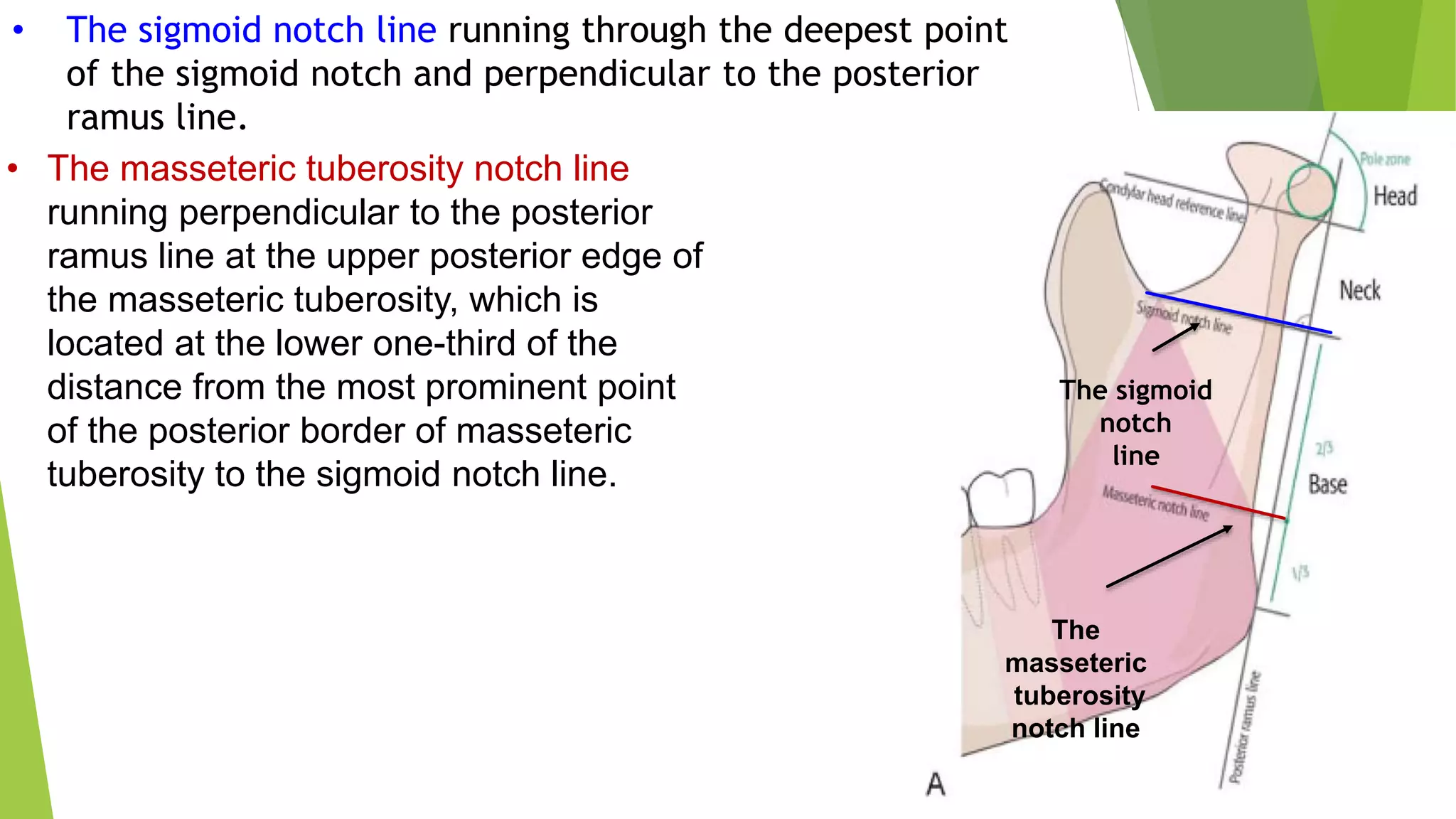 Aocmf classification . 2014, level 3 , condylar fracture , | PPTX