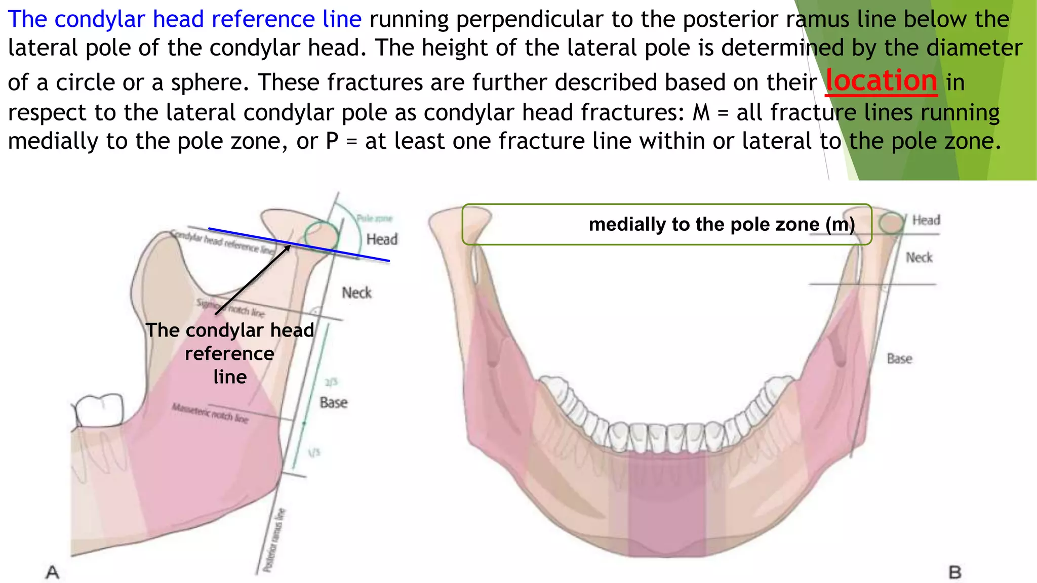 Aocmf classification . 2014, level 3 , condylar fracture , | PPTX