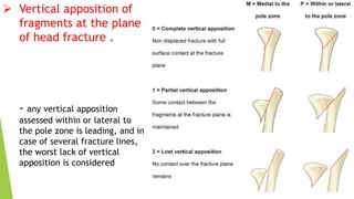 Aocmf classification . 2014, level 3 , condylar fracture , | PPTX