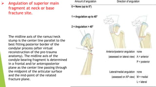 Aocmf classification . 2014, level 3 , condylar fracture , | PPTX