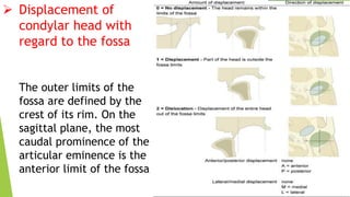 Aocmf classification . 2014, level 3 , condylar fracture , | PPTX