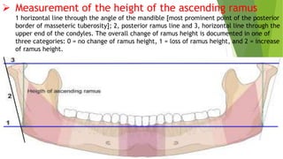 Aocmf classification . 2014, level 3 , condylar fracture , | PPTX