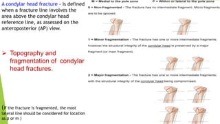 Aocmf classification . 2014, level 3 , condylar fracture , | PPTX