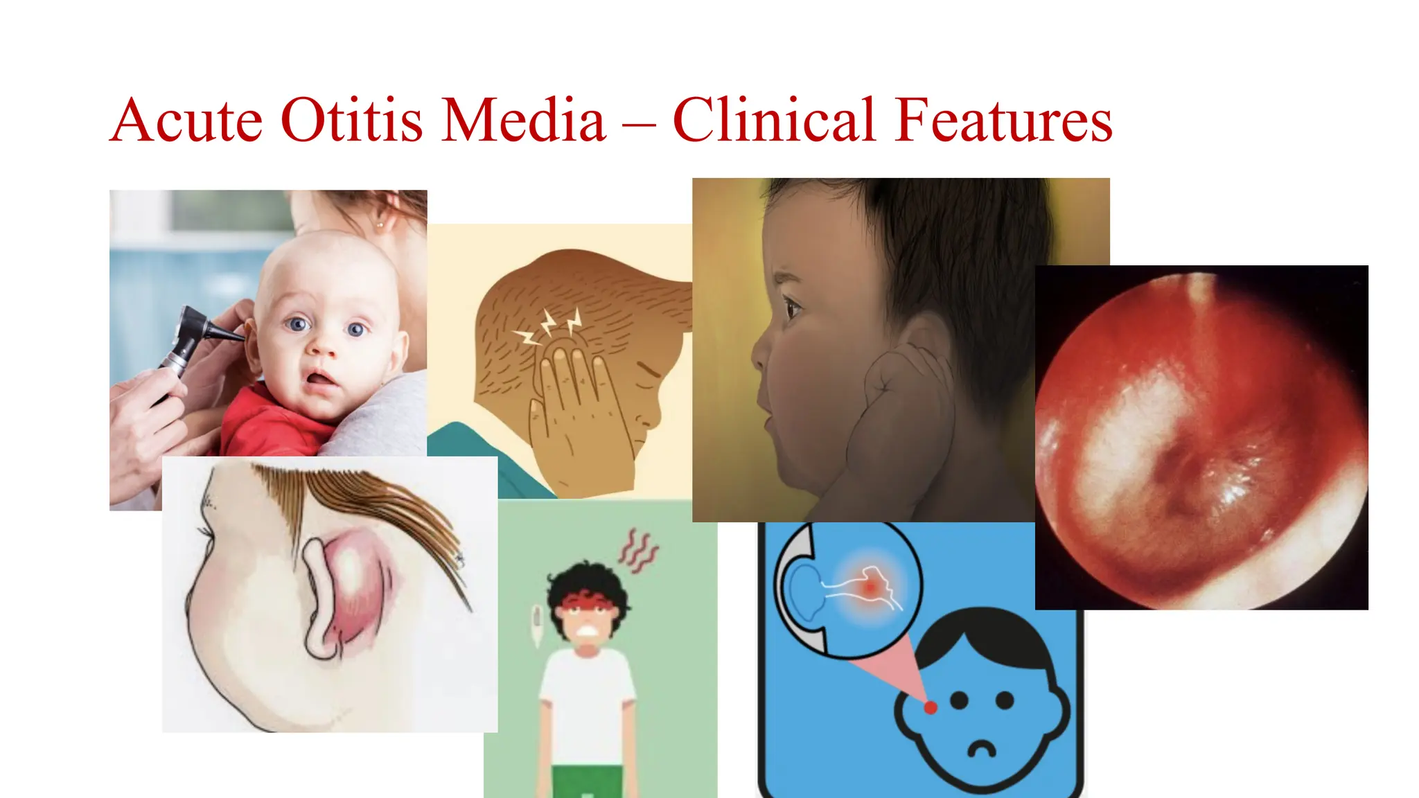 Acute Otitis Media (AOM) UG-ENT MBBS.pptx | Ear, Nose and Throat ...