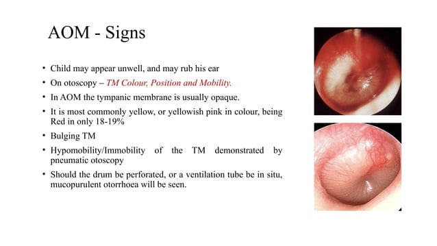 Acute Otitis Media (AOM) UG-ENT MBBS.pptx | Ear, Nose and Throat ...
