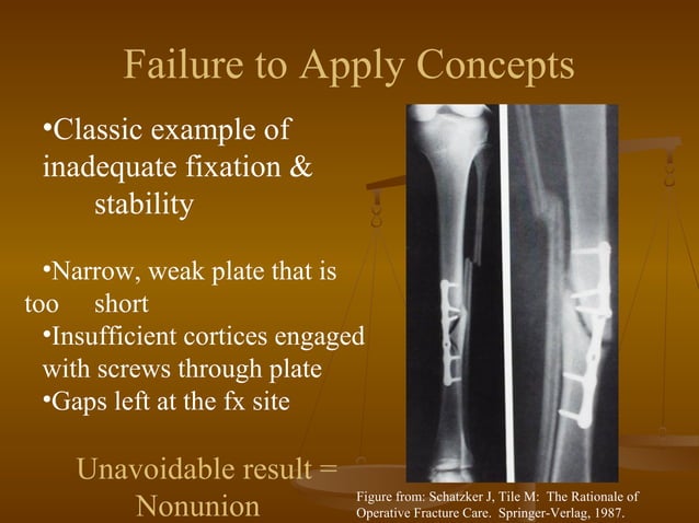 AO Principles of Fracture treatment & Different Implants. | PPT