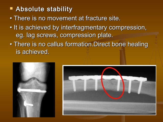 AO Principles of Fracture treatment & Different Implants. | PPT