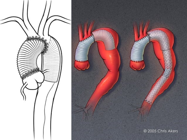 Aorta intro | PPT