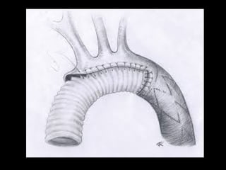 Aorta intro | PPT