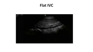 aorta & ivc-compressed pocus slides Malaysia | PDF