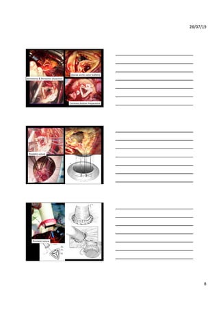 Aortic Root SUrgery | PDF