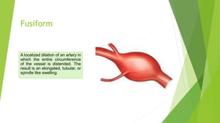 Aortic aneurysm | PPT