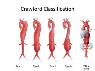 Thoracic Aortic Aneurysm Classification
