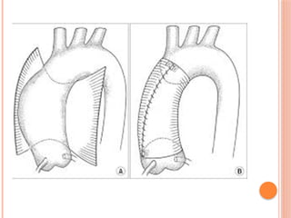 Aortic aneurysm basic, types and management | PPT