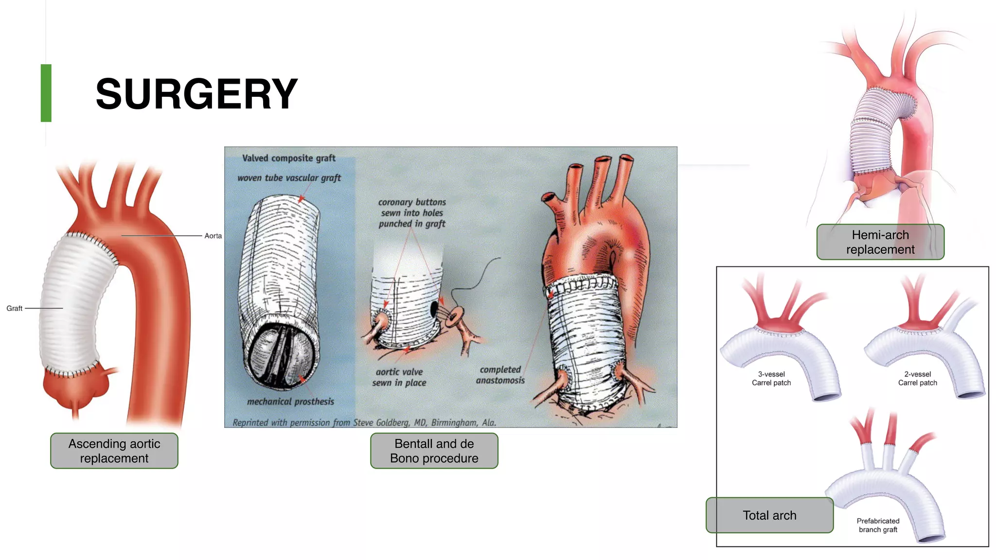 Aortic Aneurysm.pdf