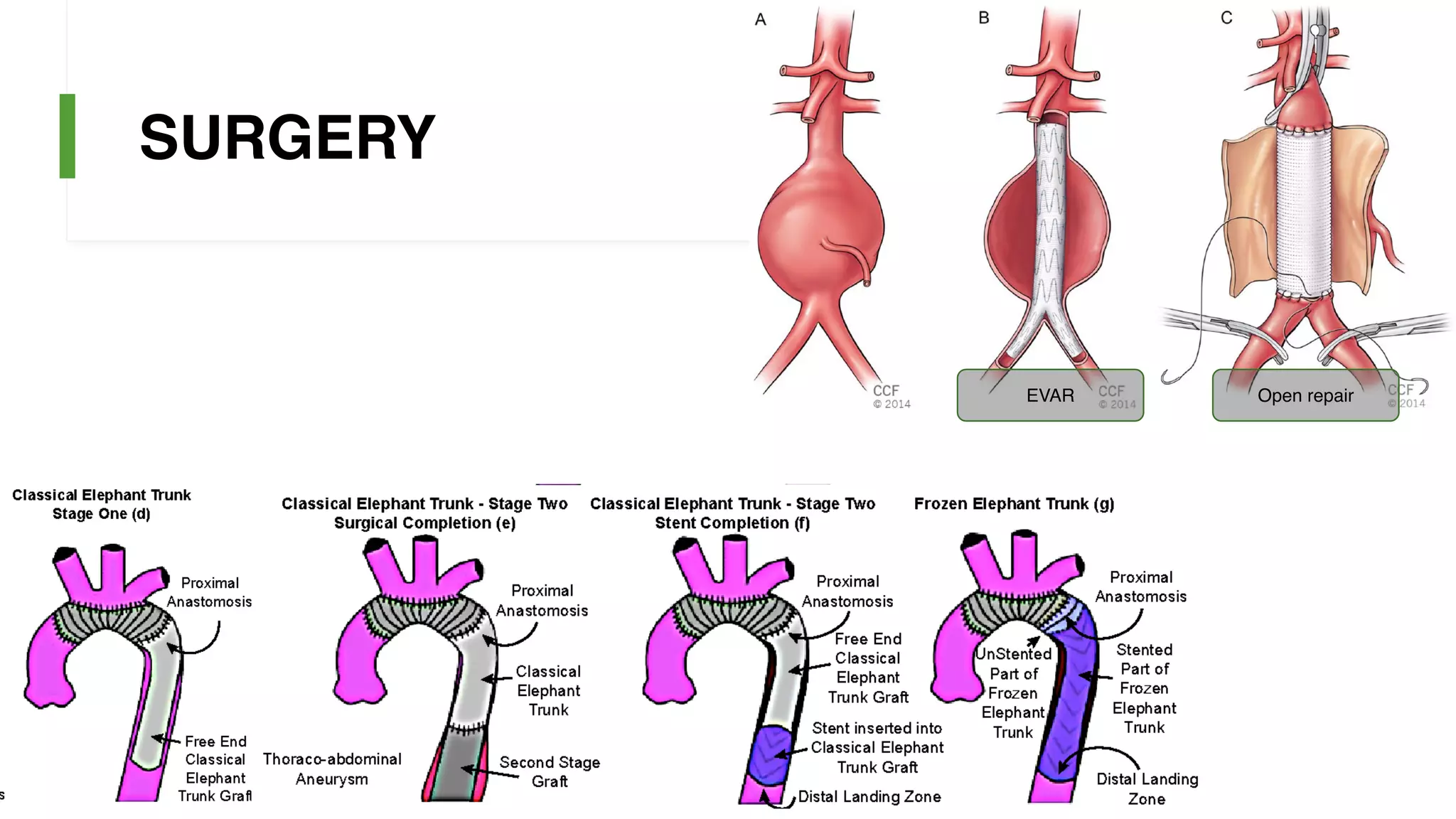 Aortic Aneurysm.pdf