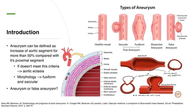 Aortic Aneurysm.pdf