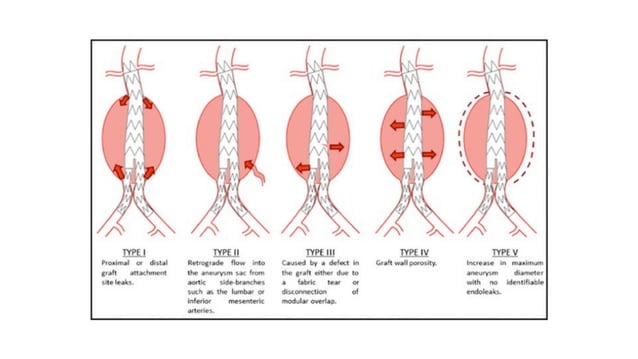 Aortic Aneurysm.pdf