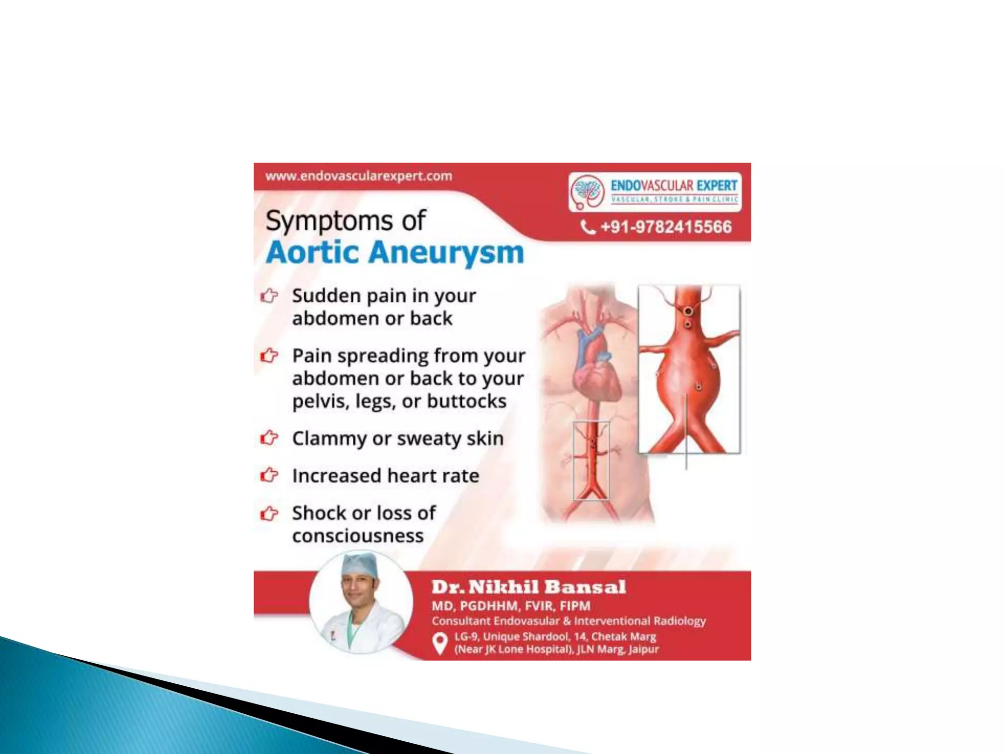 Aortic aneurysm dissection | PPTX