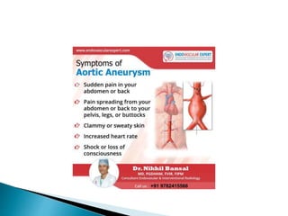 Aortic aneurysm dissection | PPTX