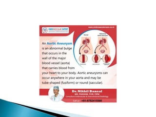 Aortic aneurysm dissection | PPTX