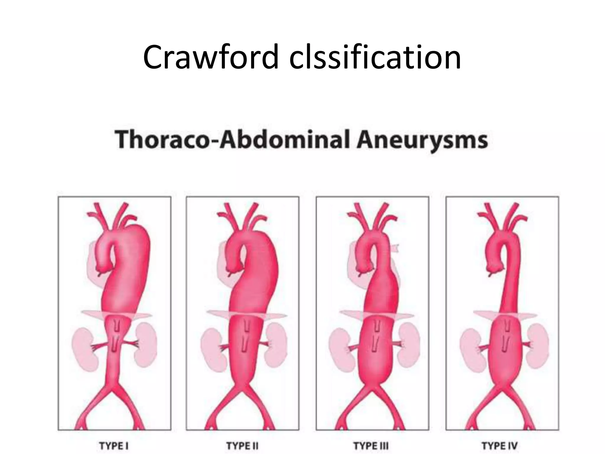 Aortic aneurysm final | PPTX
