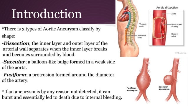 Aortic Aneurysm detailed explanation pptx | PPT