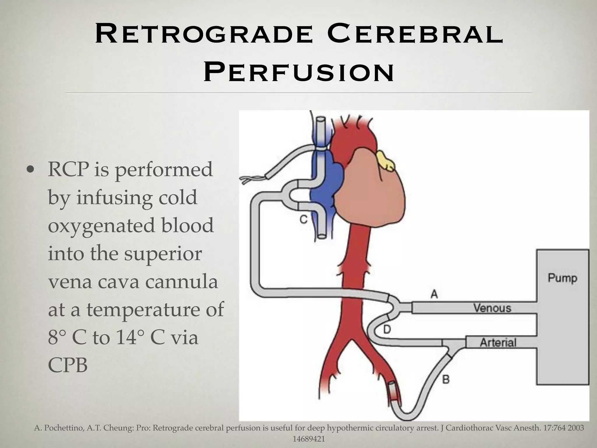 Aortic aneurysms and dissection 2016 | PDF