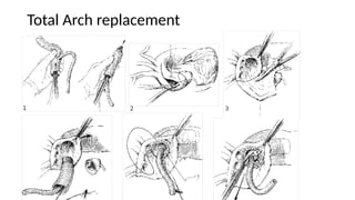 Aortic arch aneurysms in vascular surgery | PPTX